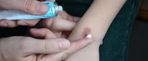 The Effect Of Correct Treatment On Burn Blister Healing Stages