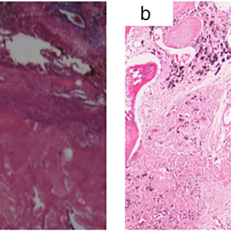 A The Primary Pulmonary Lesion Achieved A Complete Pathological