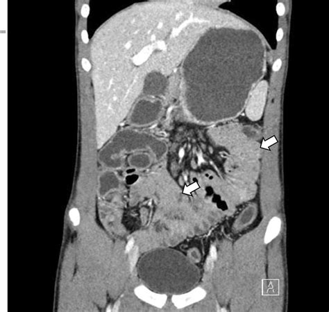 What Is Purpose Of A Ct Enterography At Jesse Gisborne Blog