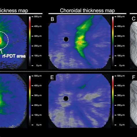 Wide Field Retinal And Choroidal Thickness Maps Before And After