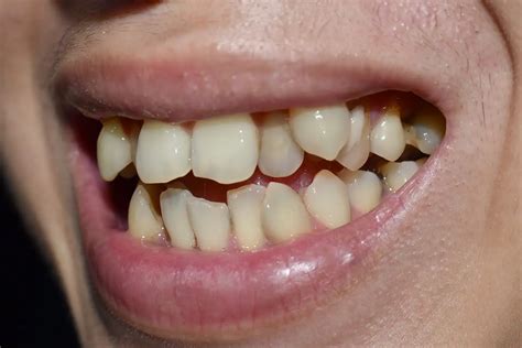 Impacted Tooth Symptoms And Complications Spring Dental