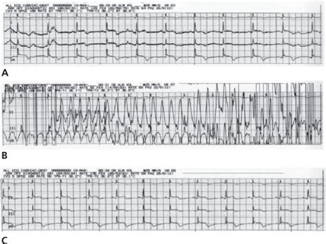 Electrocardiogram Interference A Thing Of The Past Biomedical