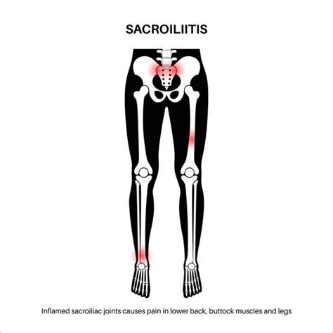 Sacroiliitis Disease Concept Inflamed Sacroiliac Joints Lower Spine