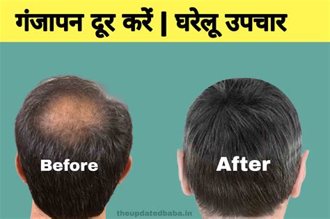 प्याज से गंजापन कैसे दूर करें जाने 5 असरदार तरीके 2024 में