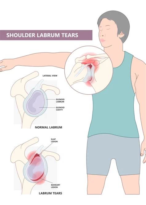 Shoulder Arthroscopy