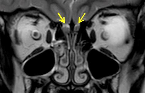 49 Endoscopic Ethmoidectomy Fess Surgical Technique Medicine