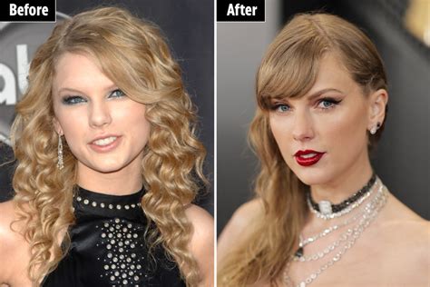 Taylor Swift Had Work Done On Her Face Says Aesthetics Doctor Her