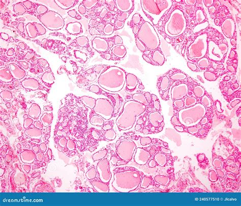 Human Thyroid Gland With Goiter Caused By Deficiency Of Iodine Under A Microscope Royalty Free