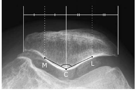 Patella Anatomy Facet