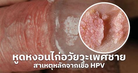 วัคซีน Hpv คืออะไร ใครบ้างควรฉีด เพื่อป้องกันมะเร็งปากมดลูก Chulalak