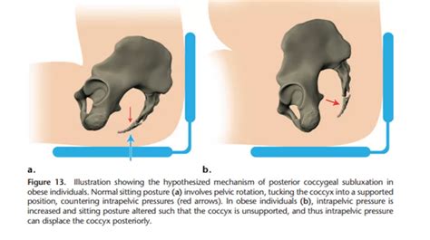 Coccydynia Sports Med Review