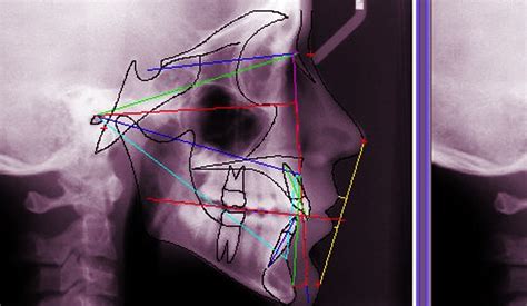 Cephtracing Johns Dental Lab