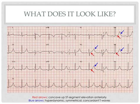 Benign Early Repolarization