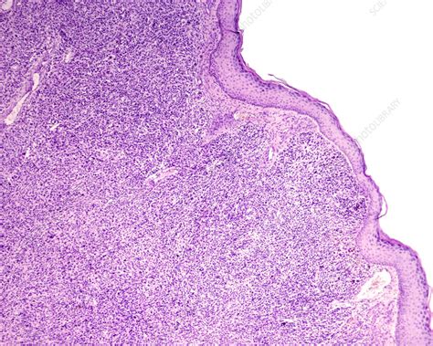Human Pleomorphic Sarcoma Light Micrograph Stock Image C0613396