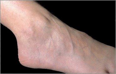 Thin And Translucent Skin With A Visible Venous Pattern On Dorsal