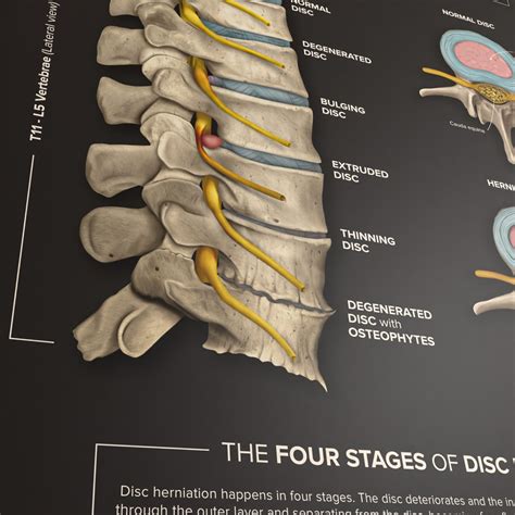 Intervertebral Disc Degeneration Poster Kirografiks