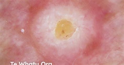 White Structureless Areas And Central Keratin In Squamous Cell
