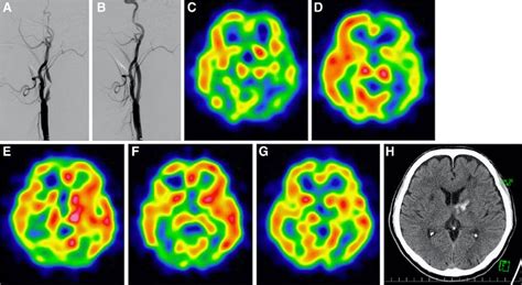 Angiogram In A 61 Year Old Man With Severe Left Extracranial Carotid