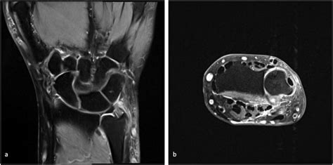 Acute Isolated Dislocation Of The Distal Radial Ulnar Joint Ulnar Volar With No Other