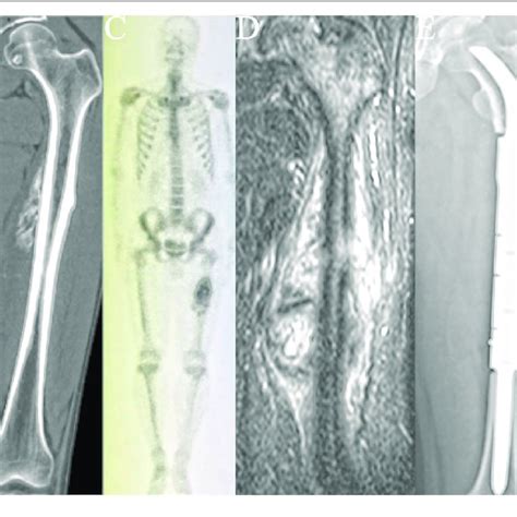 All Patients Underwent En Bloc Tumor Resection Followed By Download Scientific Diagram