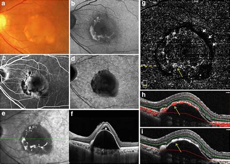 Multimodal Imaging Of Non Vascularized Ped In Amd With Lump Rpe