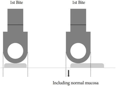 Endoscopic Instruments And Electrosurgical Unit For Colonoscopic