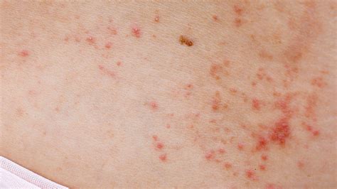 Red Bumps On Arms Not Itchy Red Bumps On Arms Not Itchy
