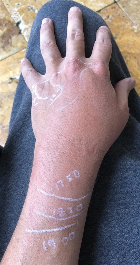 Managing Cutaneous Reactions To Yellow Fly Diachlorus Ferrugatus