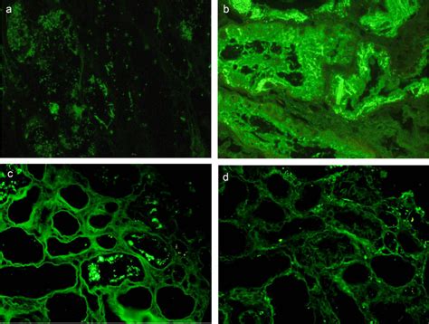 Immunofluorescence Features A Kappa Light Chain Positive