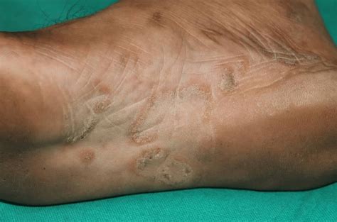 Tinea Pedis Over Right Sole Showing Hyper Pigmented Scaly Sharply