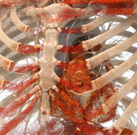 Ascending Aortic Aneurysm With Dissection Ct Angiogram Stock Image C061 3104 Science