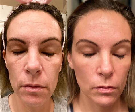 Uncover The Secret To Younger Looking Skin Anti Aging Skincare Led Li