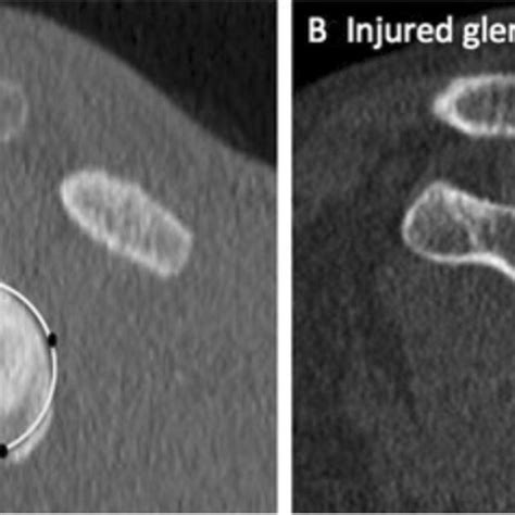 Glenoid Measurements Made Using An En Face View On T1 Weighted Mri Scan Download Scientific