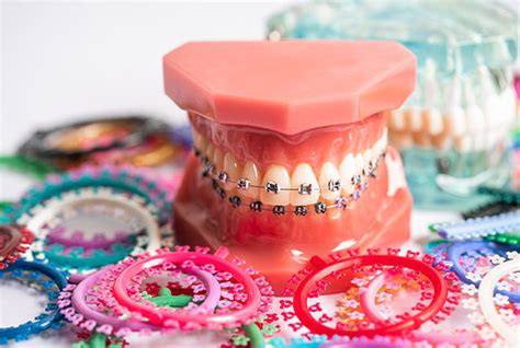 Colorful Braces Glen Waverley Teeth Straightening W A Style