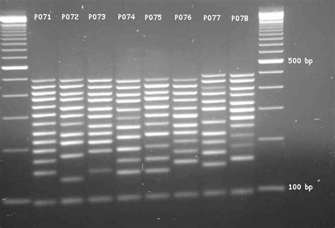 Mlpa Analysis Of The Dmd Dystrophin Gene