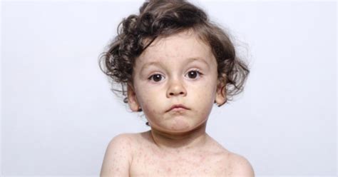 Second Measles Alert For Lismore Tweed Coast Times