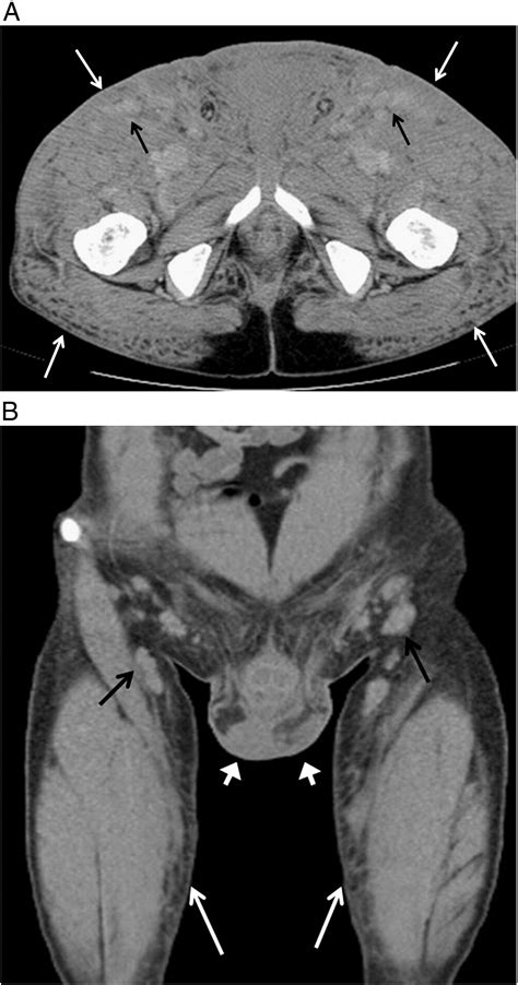 The Spectrum Of Radiological Findings In H Syndrome Clinical Imaging
