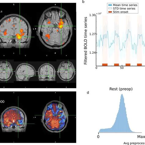 Results Of Glm Analysis On A Single Subject 307 During An Es Fmri Run