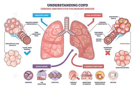 Understanding Copd Brief Visual Contrasts Healthy Lung With Copd Lung
