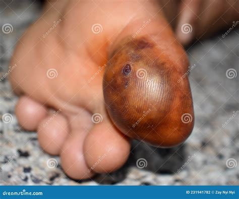 Abscess And Cellulitis Or Staphylococcal Streptococcal Skin Infection