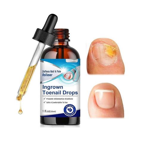 Ingrown Toenail Drops Ingrown Toenail Treatment Cuticle Care Oil For