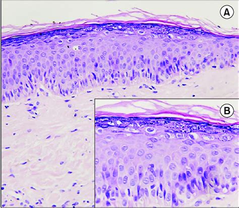 There Is A Prominent Viral Cytopathic Effect On The Keratinocytes