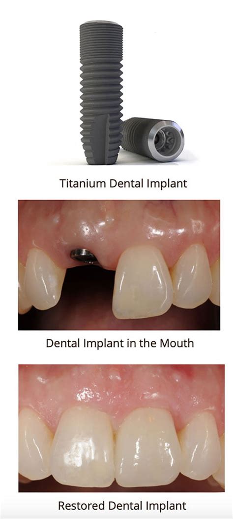 Dental Implants Vs Partial Dentures Eau Claire Park Dental