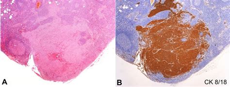Photomicrograph Of The Lymph Node Showing In A Metastatic Infiltration