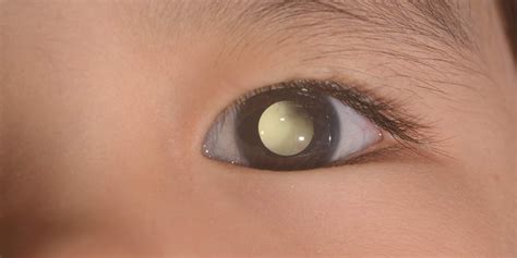 Retinoblastoma Bc Doctors Of Optometry