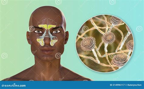 Aspergillus Svampi Som Orsak Till Sinuit 3d Illustration Som Visar