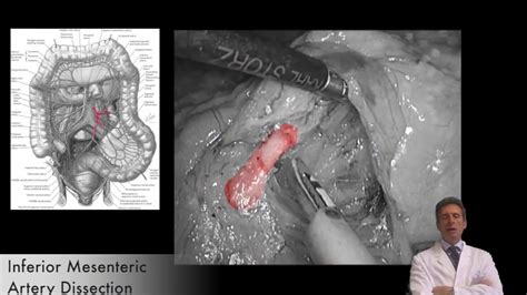 Laparoscopic Left Hemicolectomy For Cancer Step By Step General Surgery Update