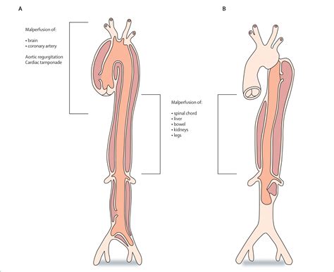 Anatomy Of Aorta