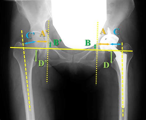 The Cup Offset A Cup Height B Stem Offset C Global Hip Offset