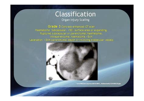 Spleen Trauma Classification Pdf